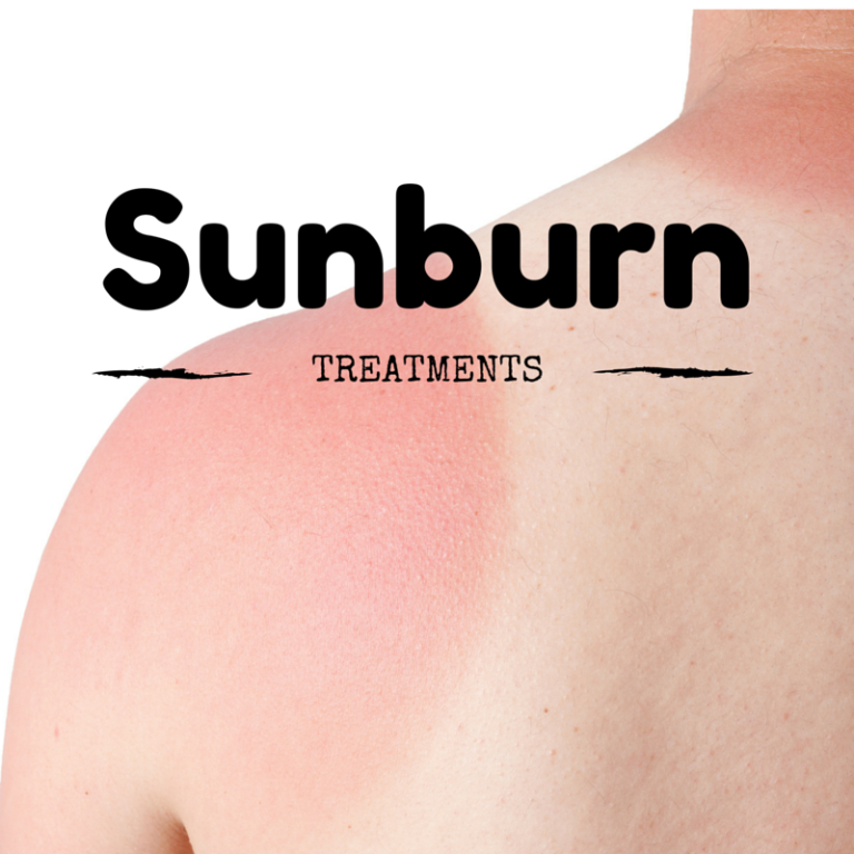 Sunburn Treatment - Soothing A Burn — Thrifty Mommas Tips